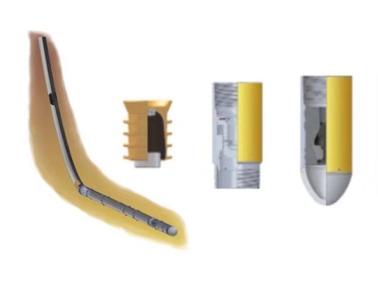 Casing Buoyancy System for Deepwater Operations